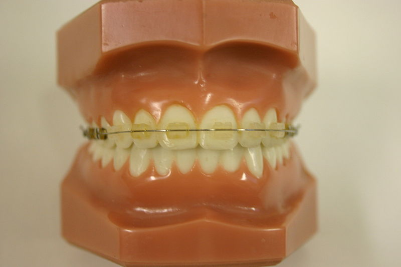 The Four Most Common Types of Dental Braces | PacificWest Dental The Four Most Common Types of Dental Braces | PacificWest Dental