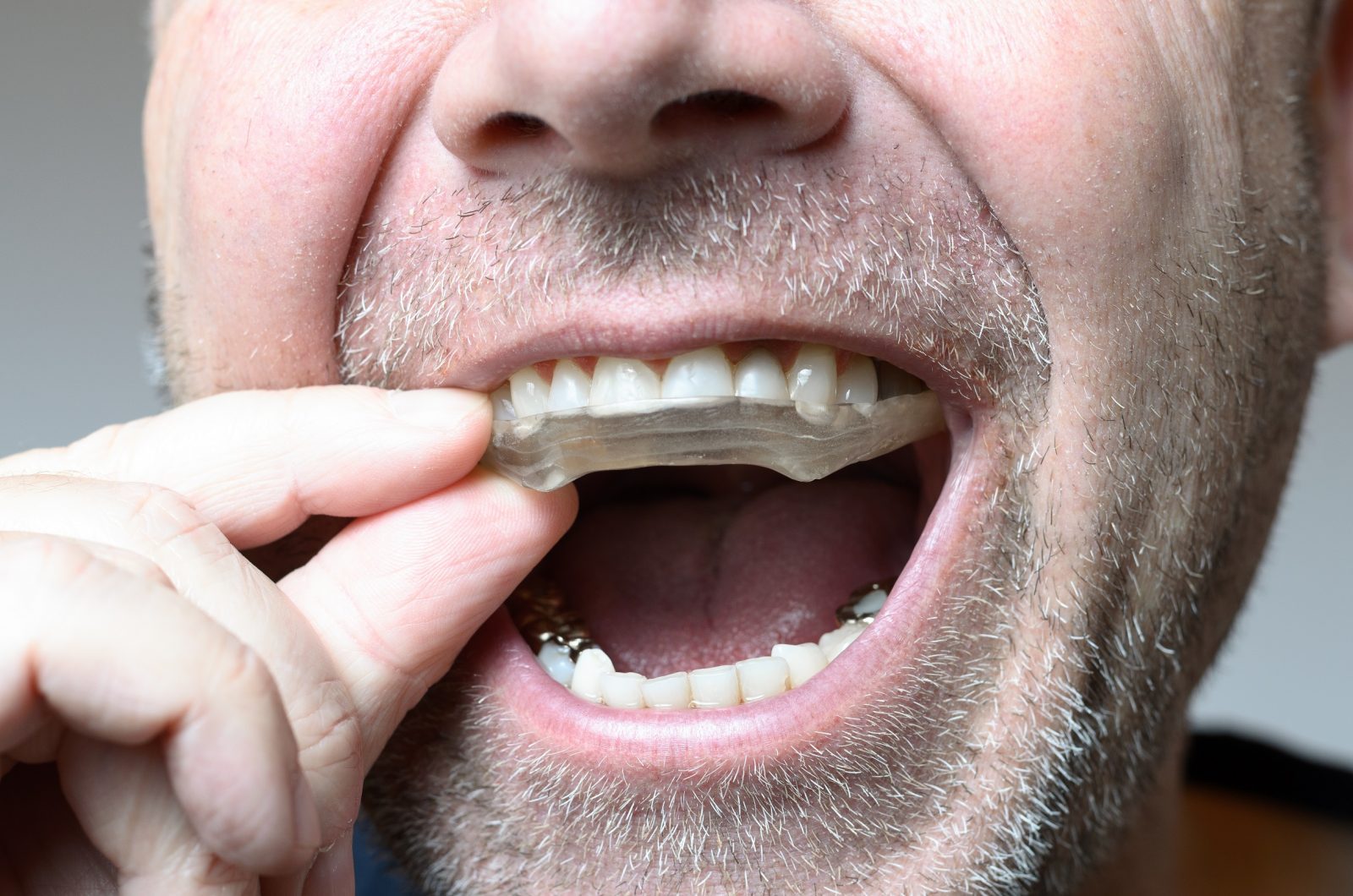 Teeth Grinding and Clenching | Pacific West Dental Blog