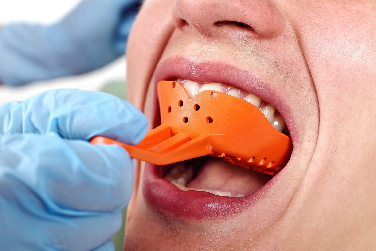 Dental Impressions| Pacific West Dental Blog